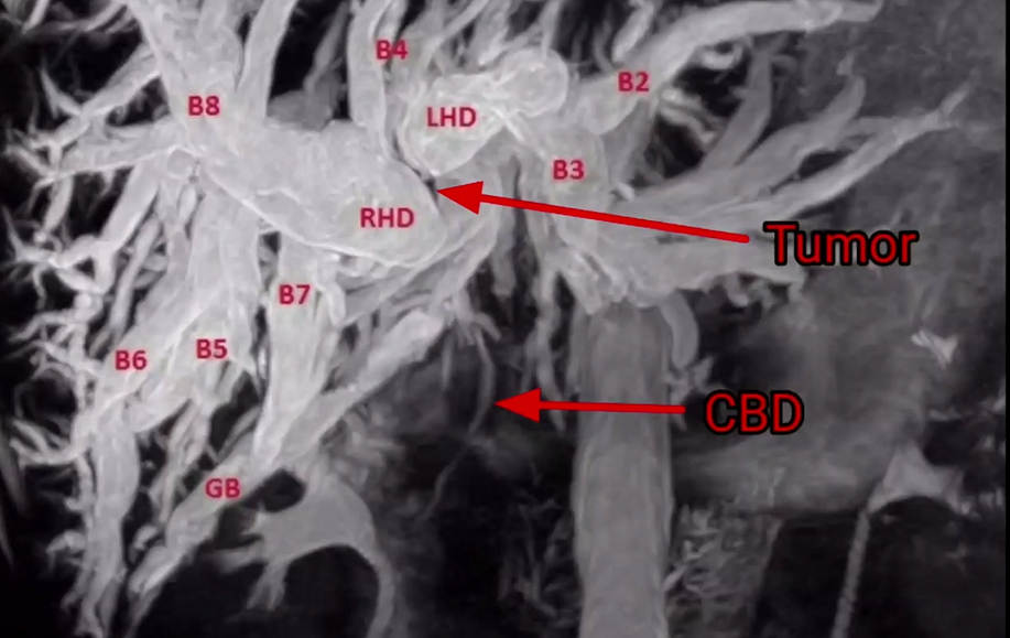Klatskin Tumor Ultrasound